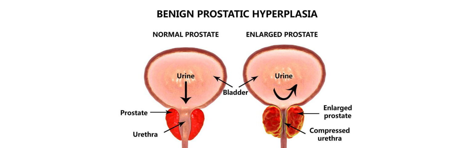 May 2024 Newsletter : Benign Prostate Hyperplasia (BPH) - Guy ...